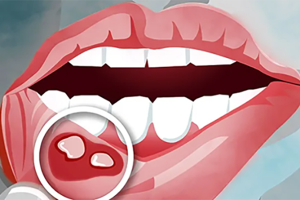 Co pomáhá na afty? | HERBADENT SHOP